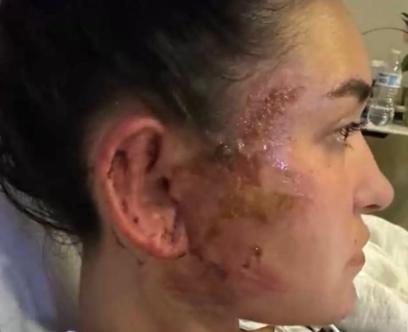 Woman hit by Volusia lifeguard truck on beach in Daytona files lawsuit