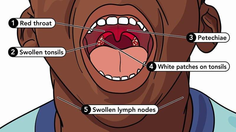 It's strep throat 'high' season. See symptoms, treatment, Ohio cases